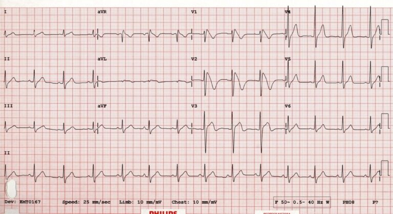 ECG – clinnextcro